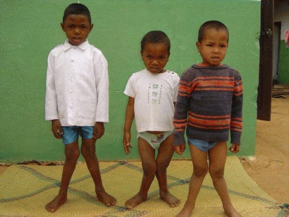 Hay 200 millones de niños con raquitismo - El mundo | Diario La Prensa